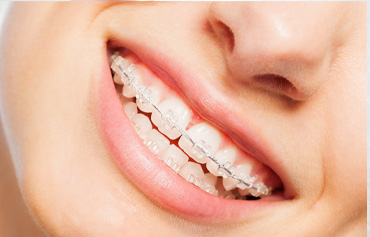 Clear Braces - ORLAND PARK ORTHODONTICS